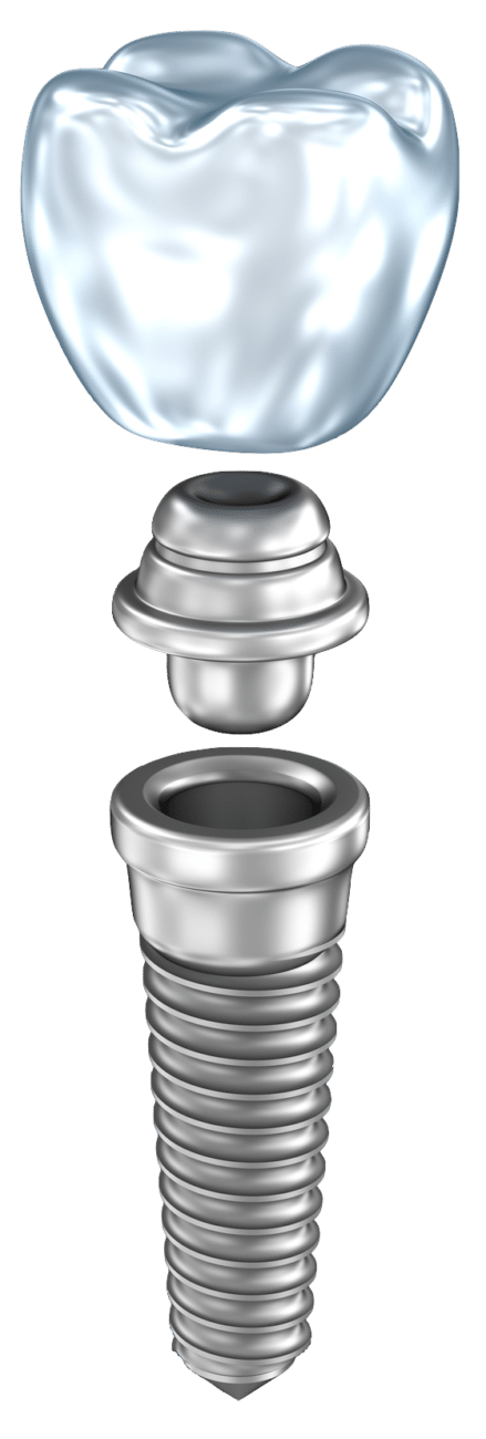 What are Dental Implants? | Claremont CA Implant Dentists