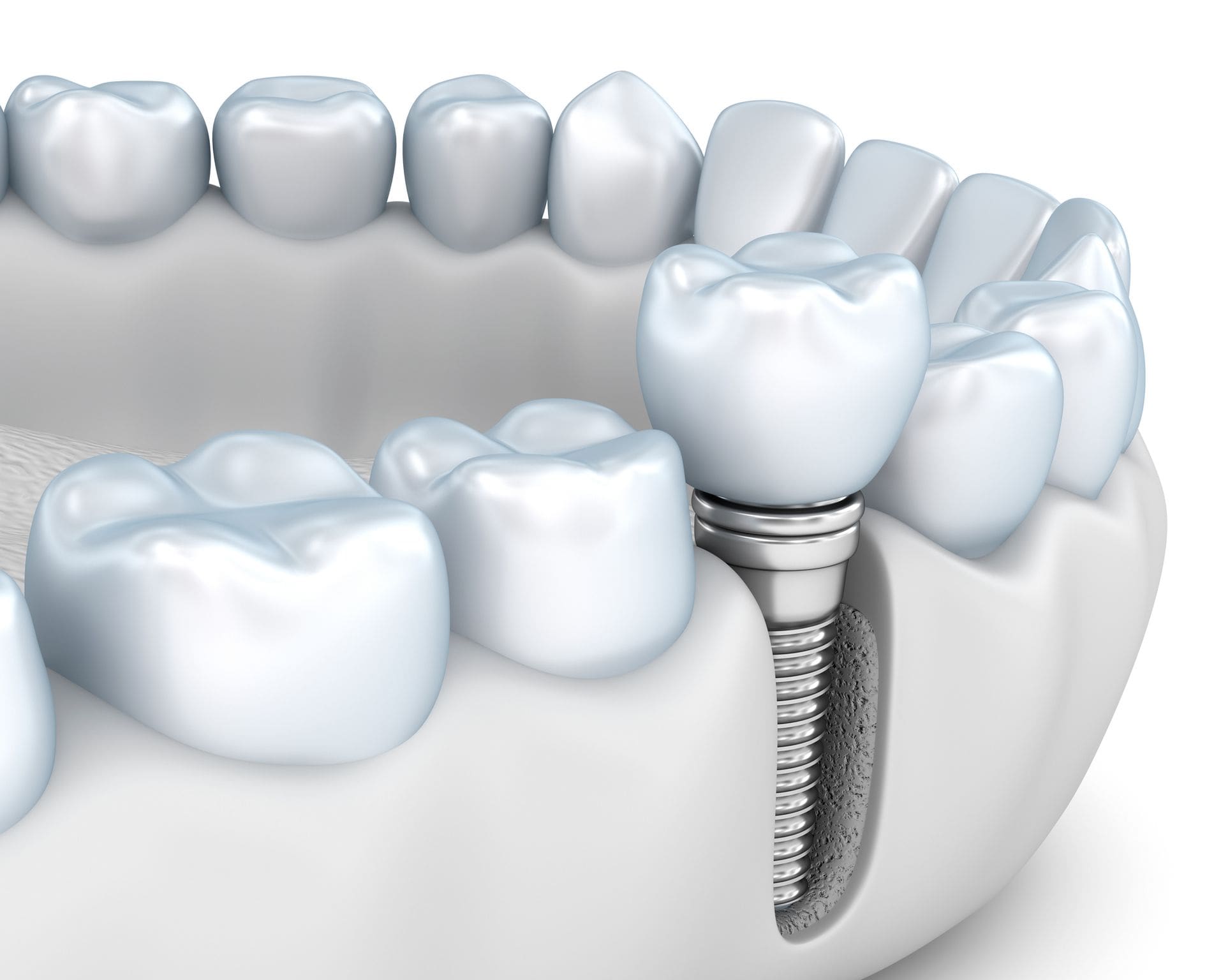 Protect Your Jaw After Tooth Loss - Dentist in Claremont, CA