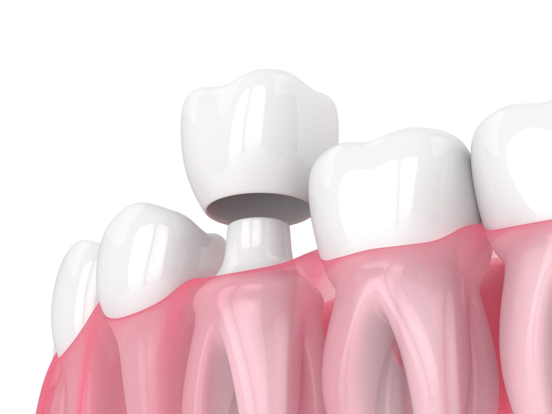 Discover the Dental Crown Process - Dentist in Claremont, CA